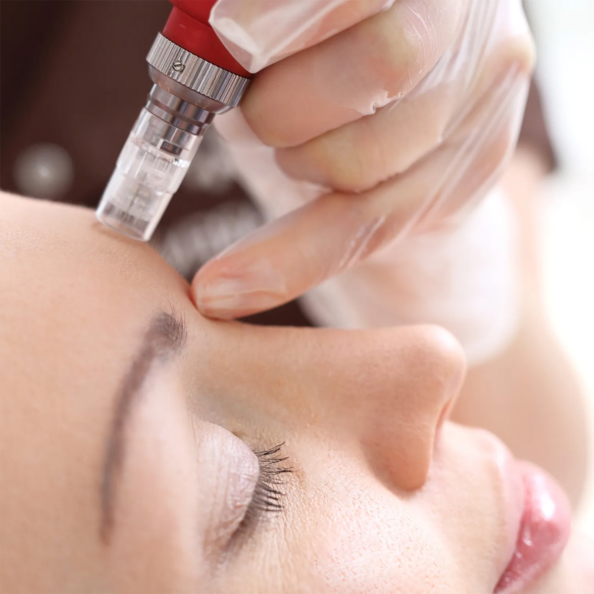 Maximizing Benefits with Micro-Needling and Retinol Boosters - Athame ...
